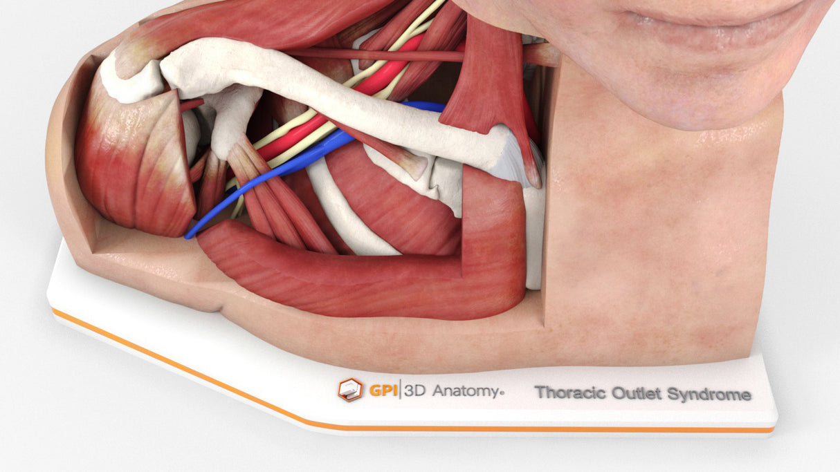 Custom 3D Anatomy Models | Thoracic Outlet Syndrome (TOS) | Thoracic ...