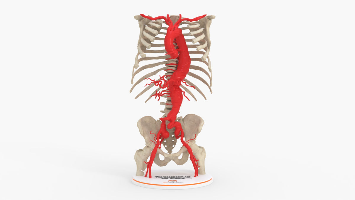 Custom 3D Anatomy Models | Aortic Aneurysm | Thoracoabdominal Bilateral ...