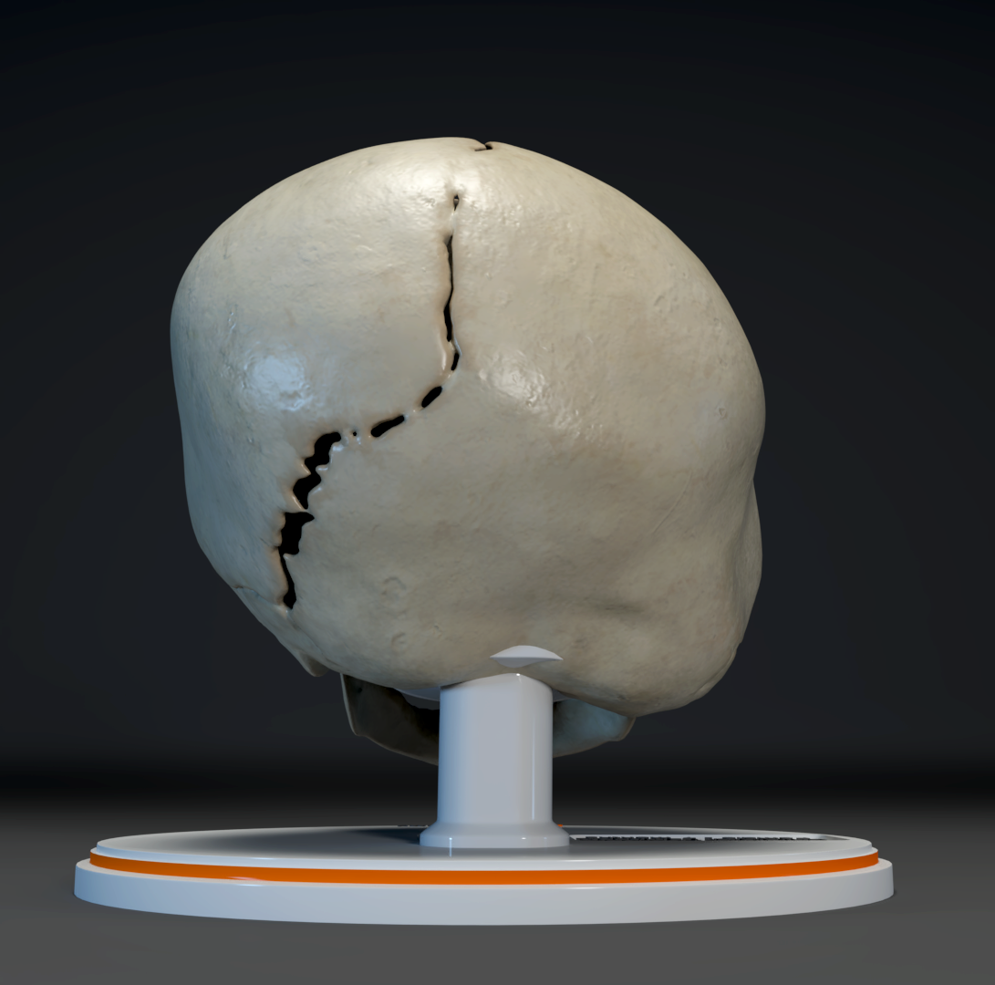 Custom 3D Anatomy Models | Craniosynostosis | Lambdoid Suture ...