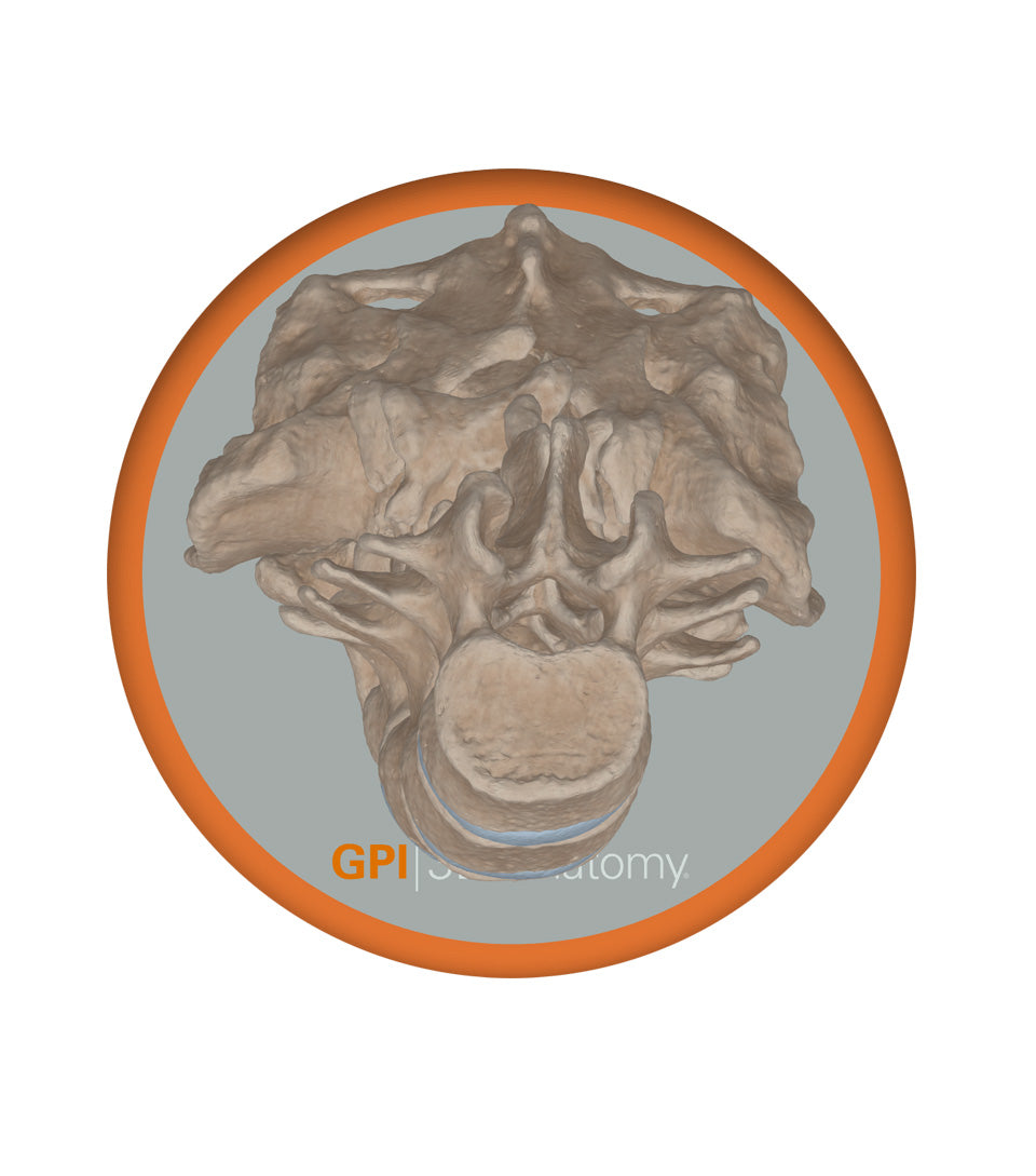 Custom 3D Anatomy Models | Spine | Spondylolisthesis | Pars Defect ...