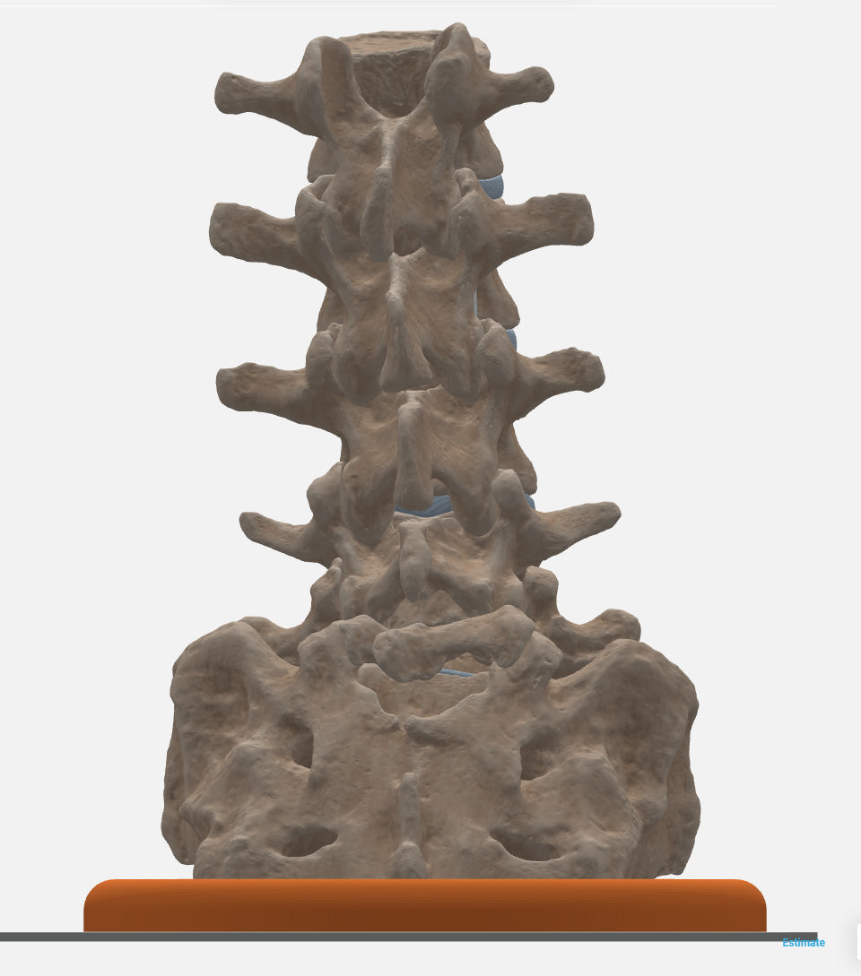 Custom 3D Anatomy Models | Spine | Spondylolisthesis | Pars Defect ...