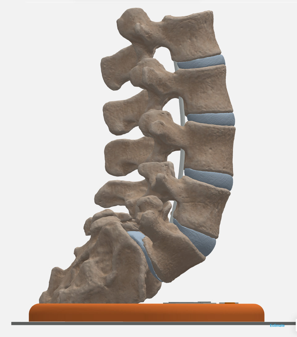 Custom 3D Anatomy Models | Spine | Spondylolisthesis | Pars Defect ...