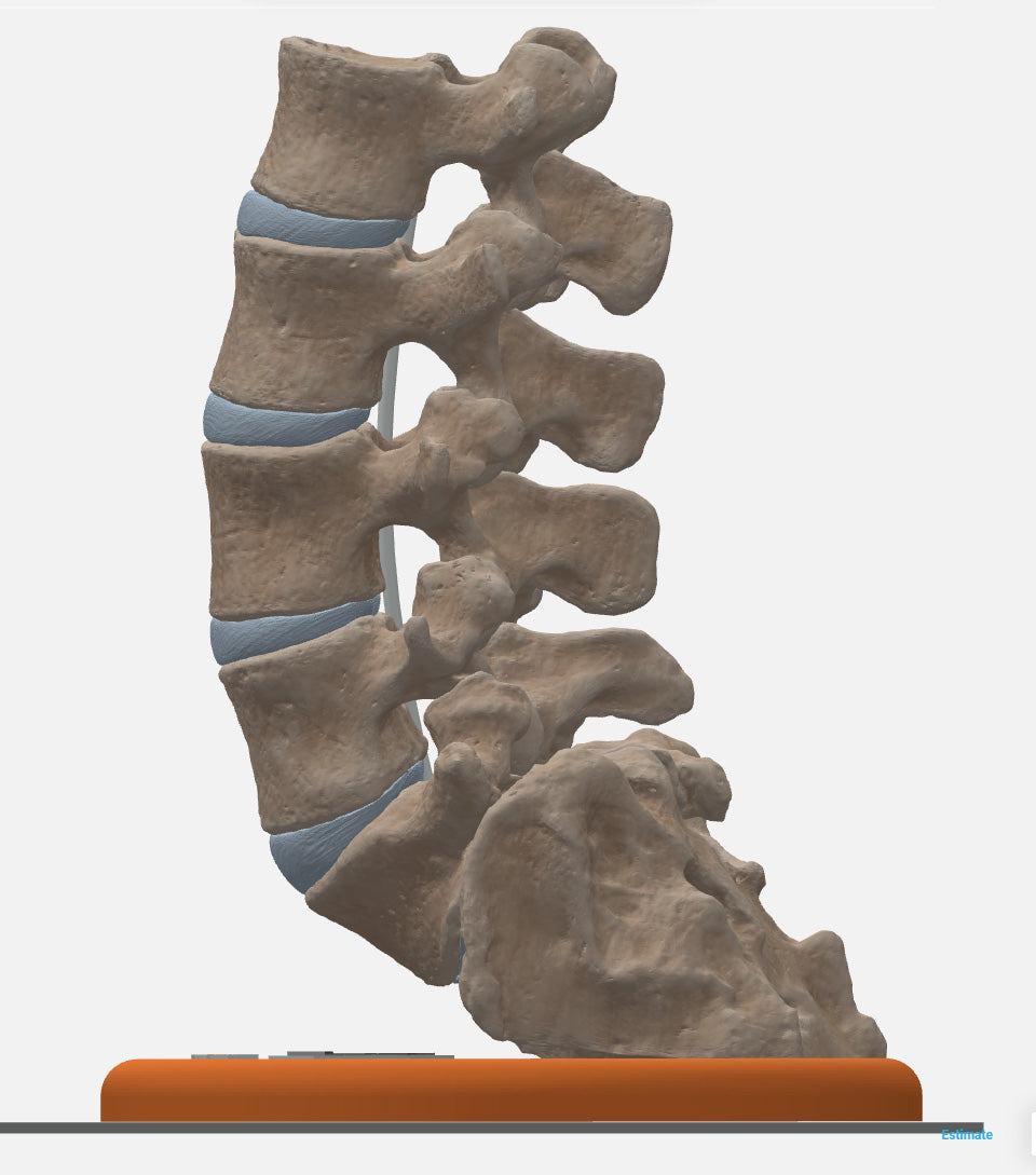 Custom 3D Anatomy Models | Spine | Spondylolisthesis | Pars Defect ...