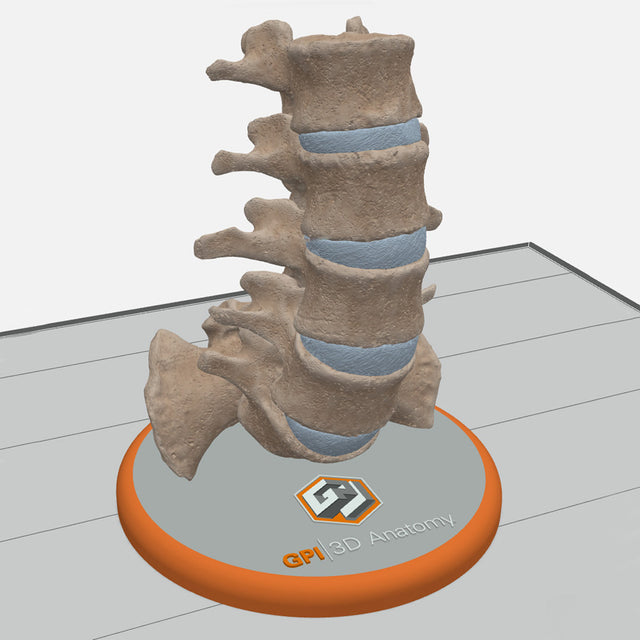 Custom 3D Anatomy Models | Spine | Spondylolysis | Pars Defect | Grade ...