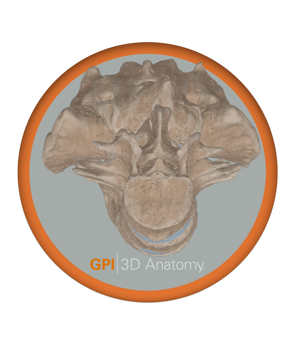 Custom 3D Anatomy Models | Spine | Spondylolysis | Pars Defect | Grade ...