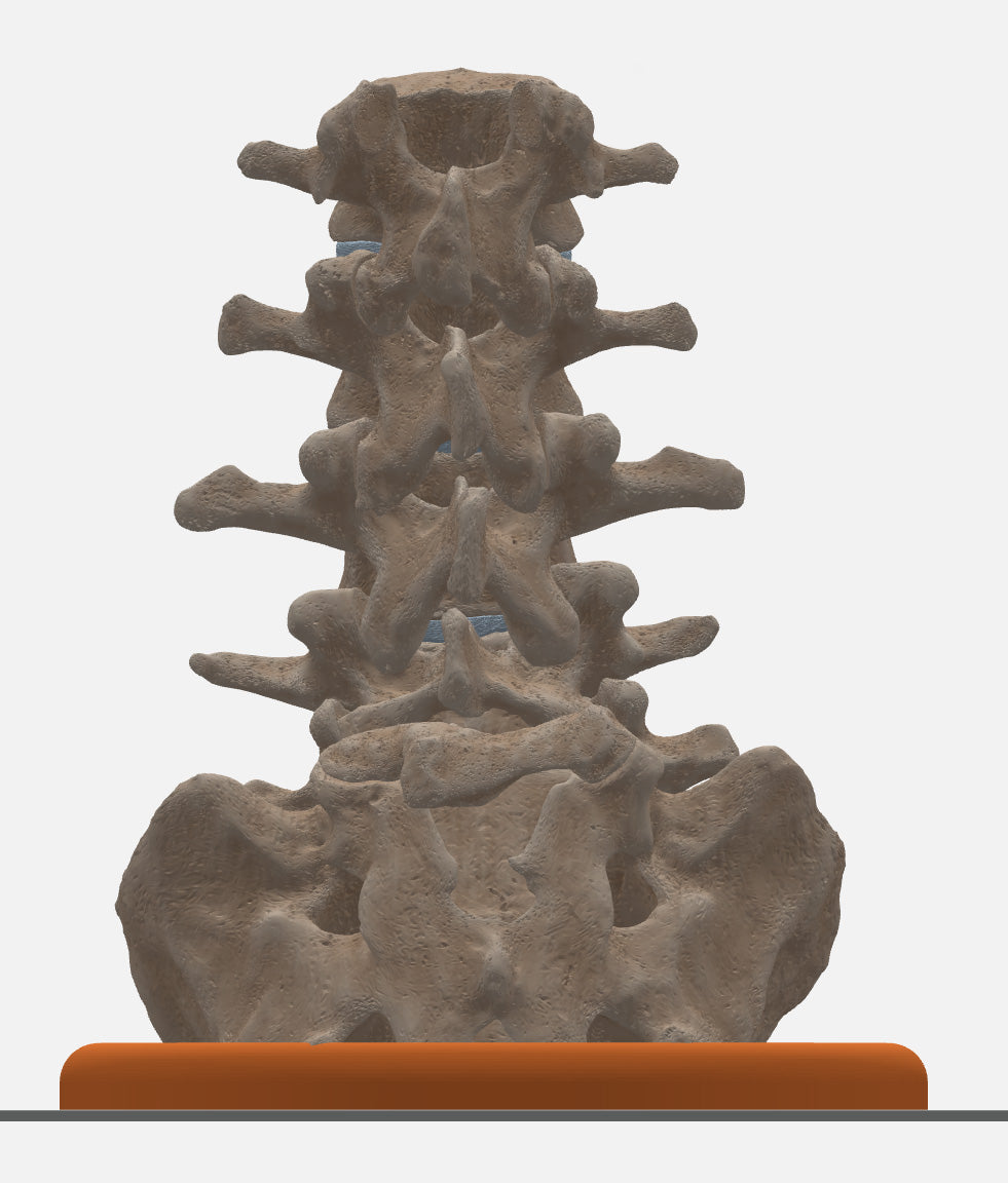 Custom 3D Anatomy Models | Spine | Spondylolysis | Pars Defect | Grade ...