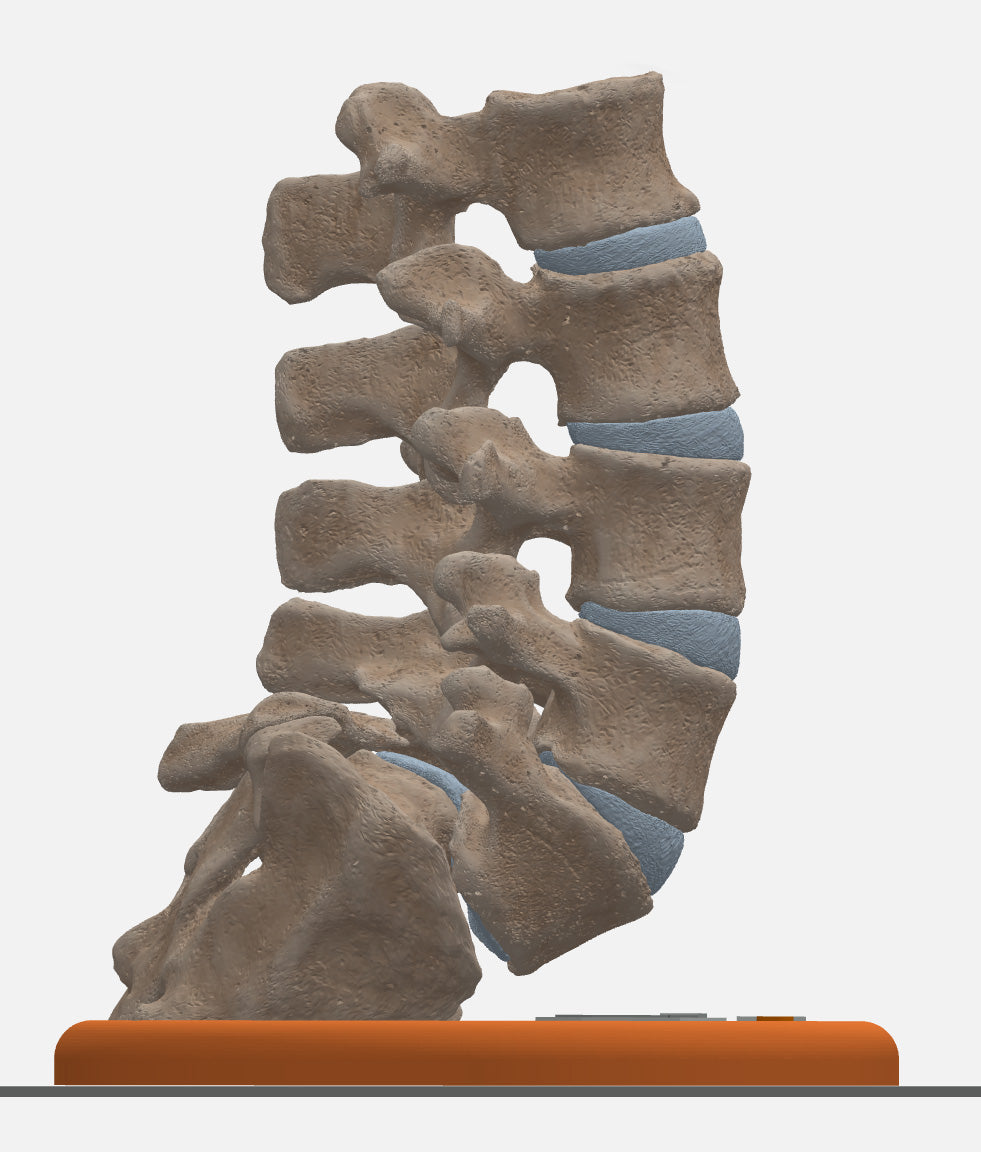 Custom 3D Anatomy Models | Spine | Spondylolysis | Pars Defect | Grade ...