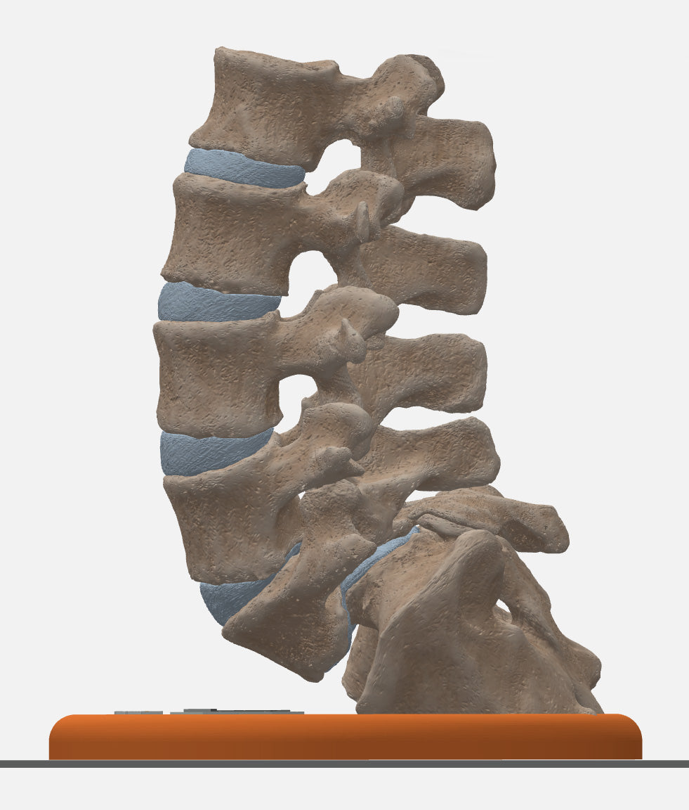 Custom 3D Anatomy Models | Spine | Spondylolysis | Pars Defect | Grade ...
