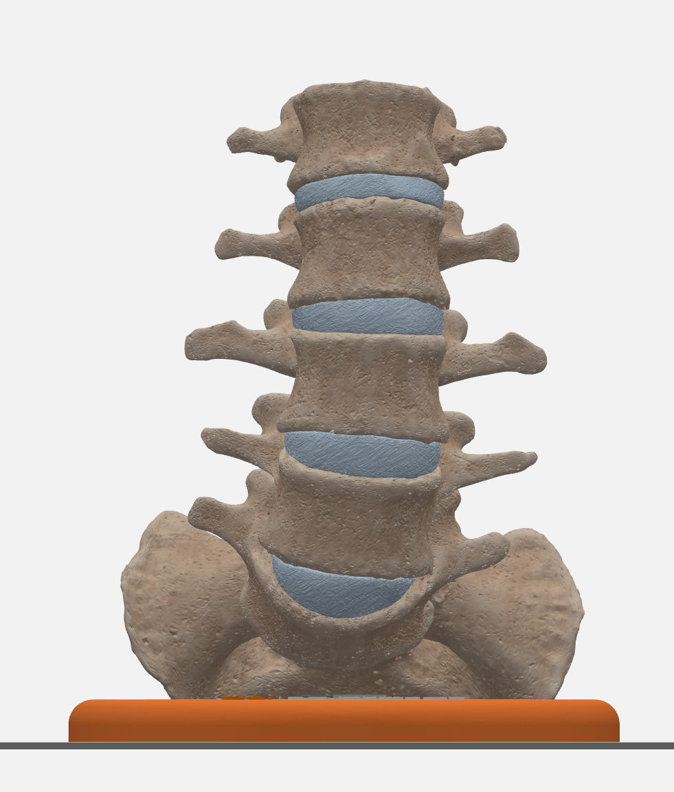 Custom 3D Anatomy Models | Spine | Spondylolysis | Pars Defect | Grade ...