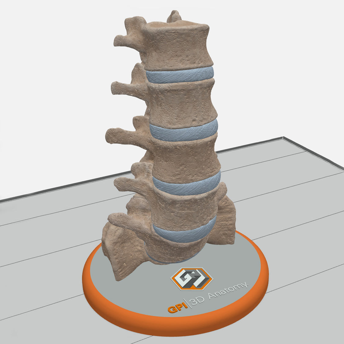 Custom 3D Anatomy Models | Spine | Spondylolysis | Pars Defect | Grade ...