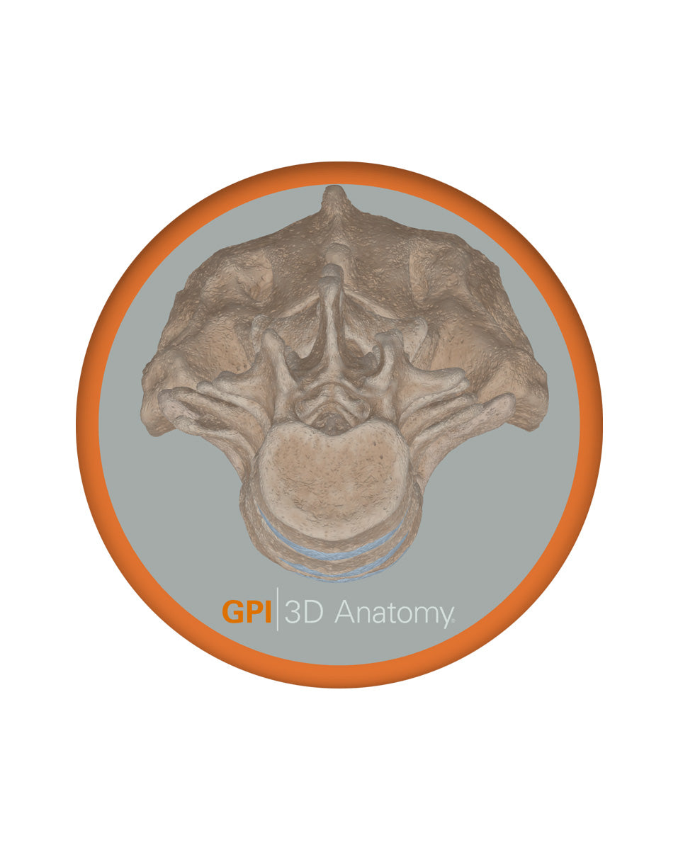Custom 3D Anatomy Models | Spine | Spondylolysis | Pars Defect | Grade ...