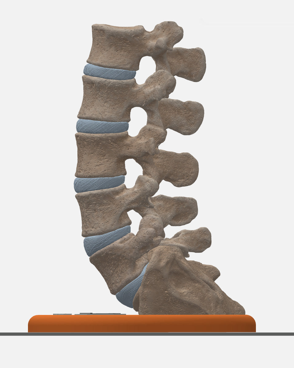 Custom 3D Anatomy Models | Spine | Spondylolysis | Pars Defect | Grade ...