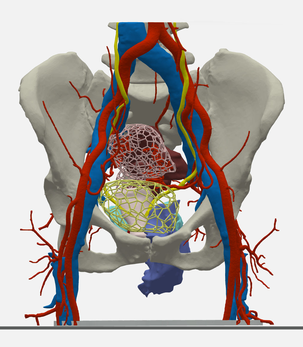 Custom 3D Anatomy Models | Perineal Hernia | Pelvic Floor Dysfunction ...