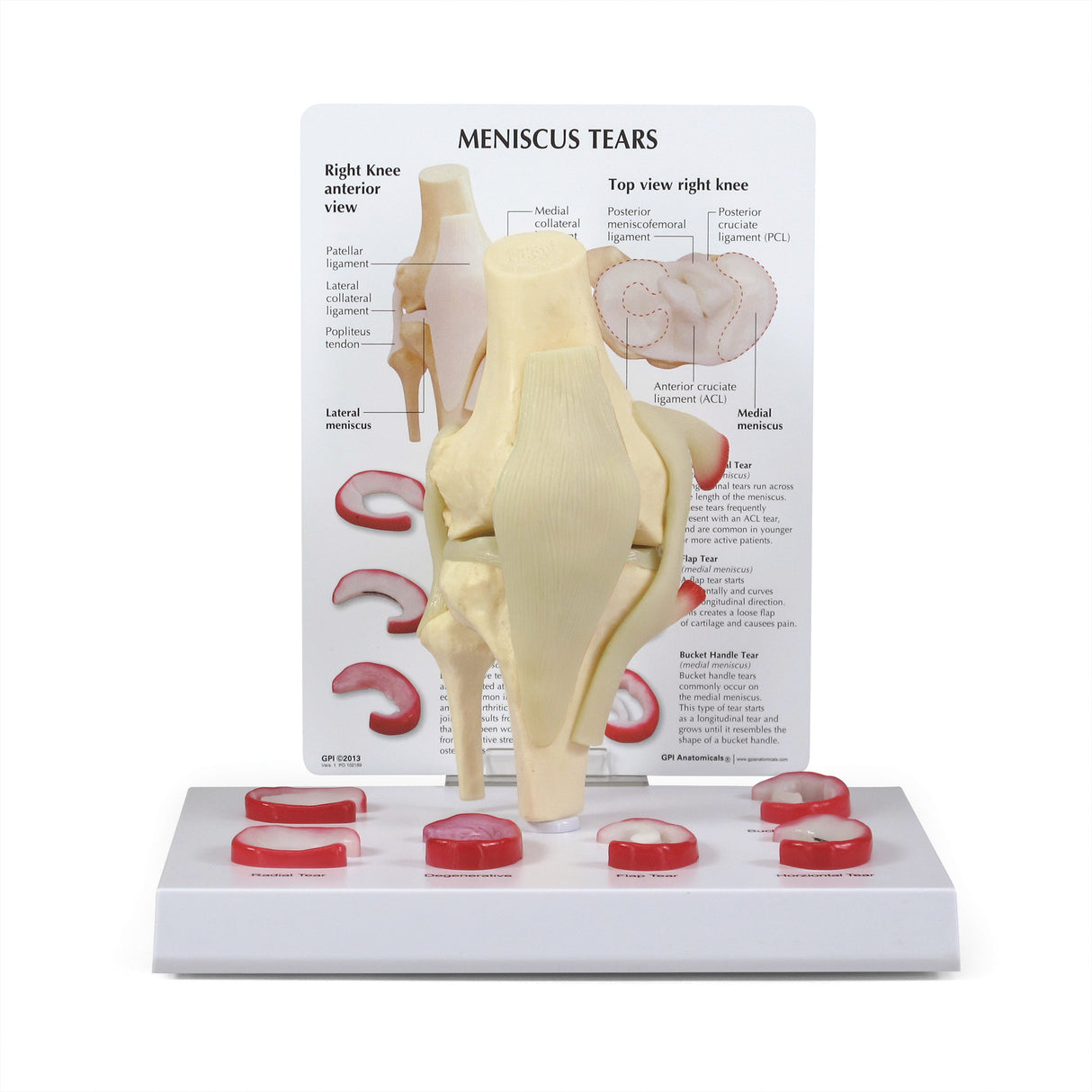 Knee Model with Meniscus Tears – GPI 3D Anatomy