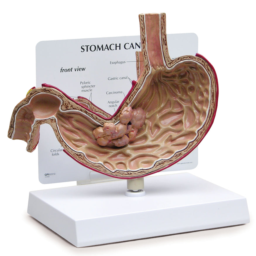Stomach Cancer Education Card – GPI 3D Anatomy