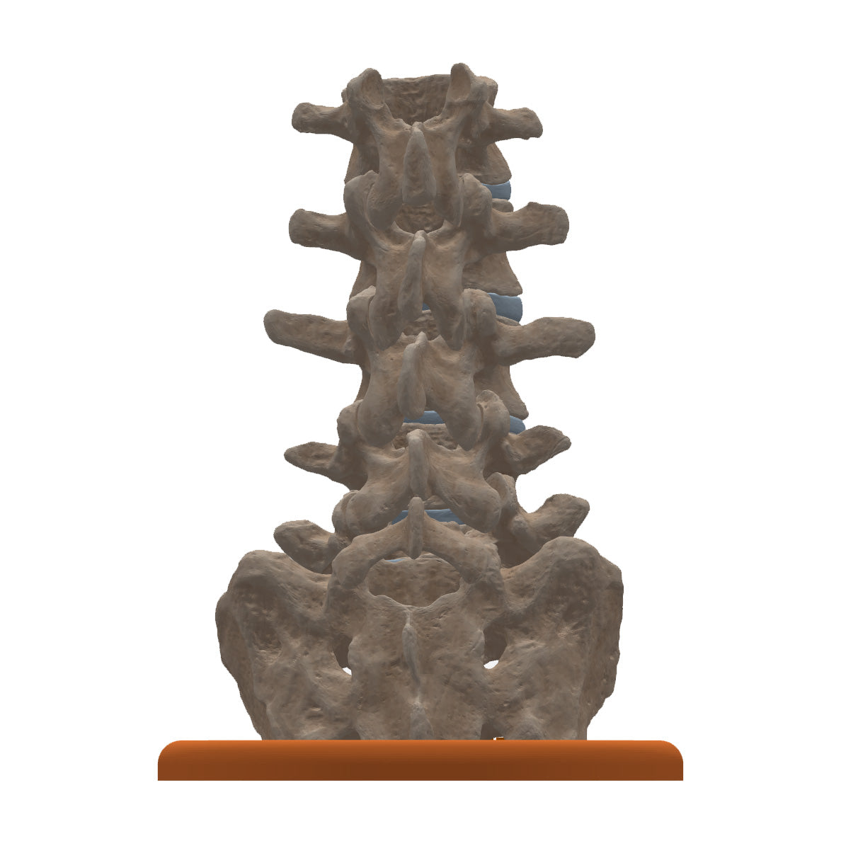 Custom 3D Anatomy Models | Spine | Spondylolysis | Pars Defect | Grade ...