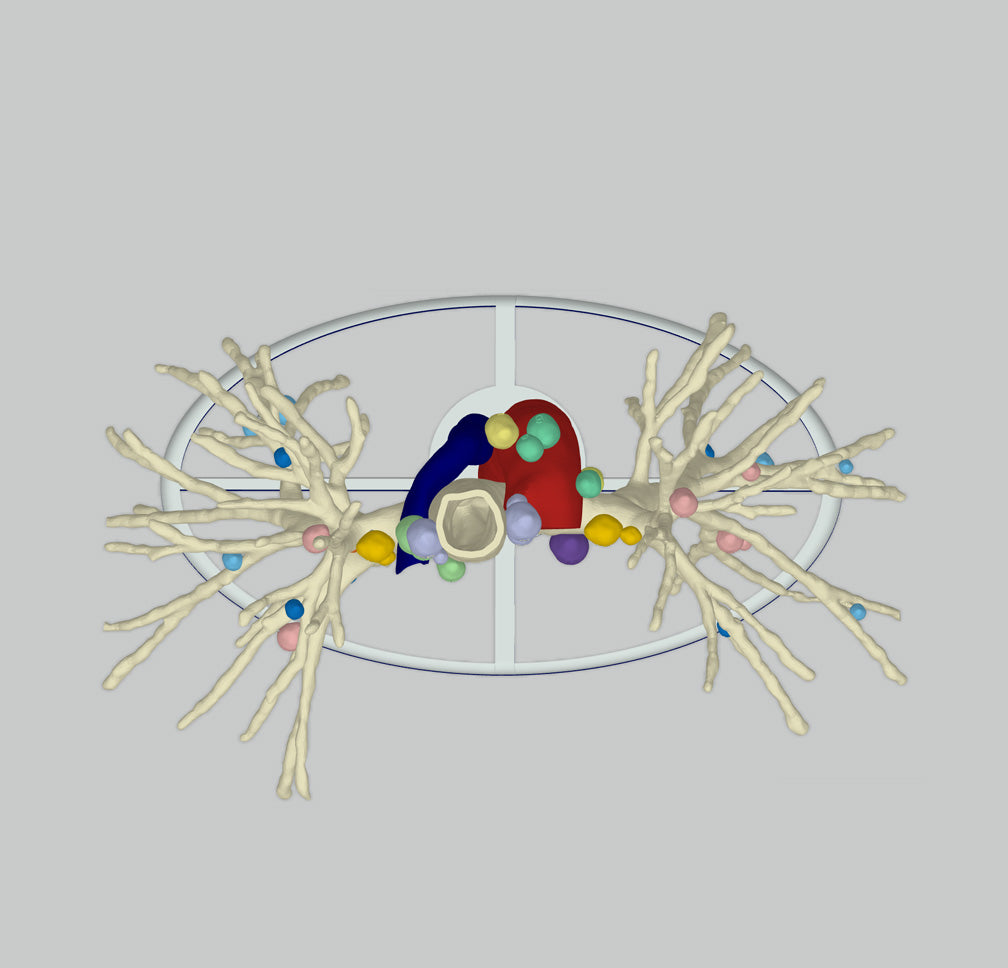 Custom 3D Anatomy Models | Tracheobronchial Tree With Lymph Nodes ...
