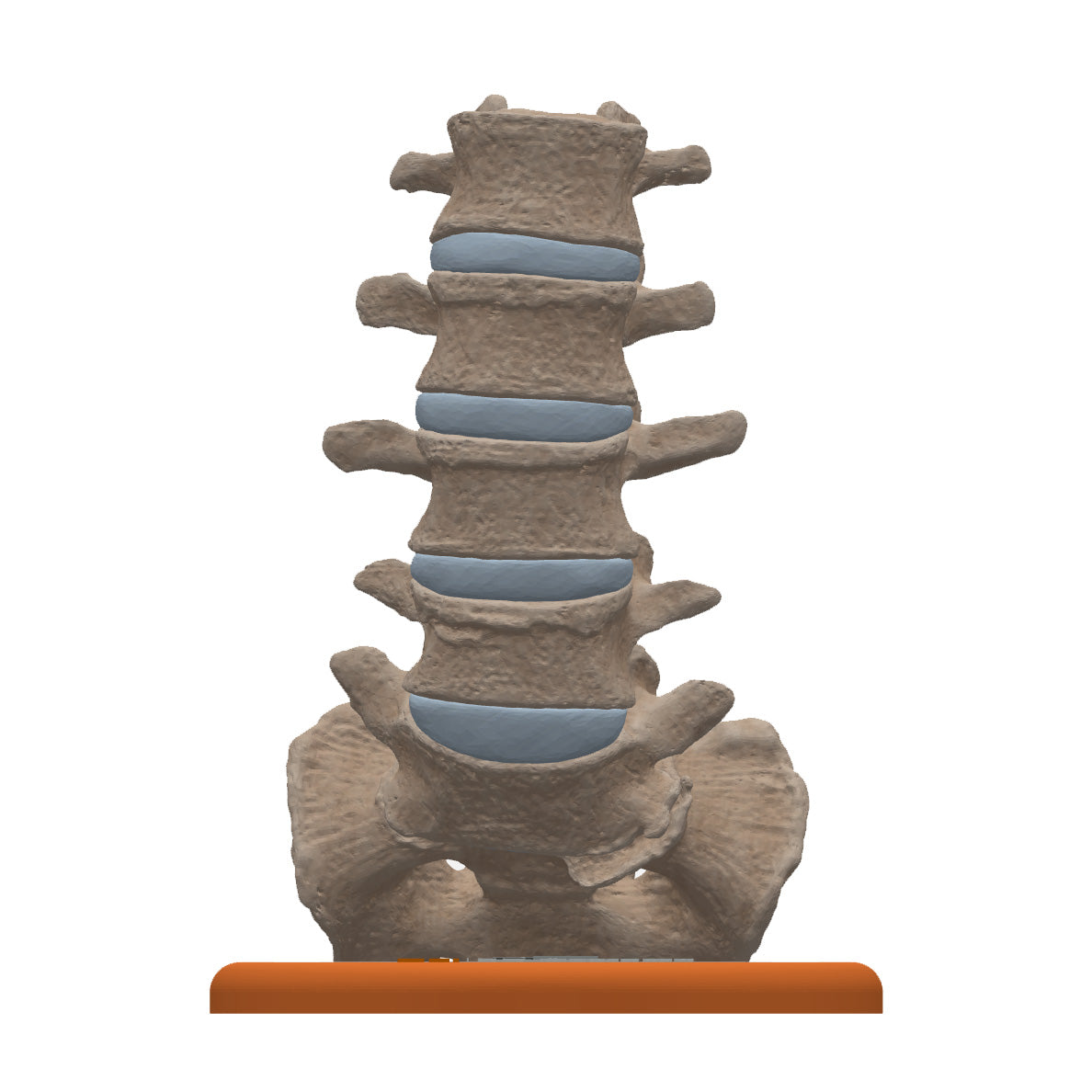 Custom 3D Anatomy Models | Spine | Spondylolysis | Pars Defect | Grade ...