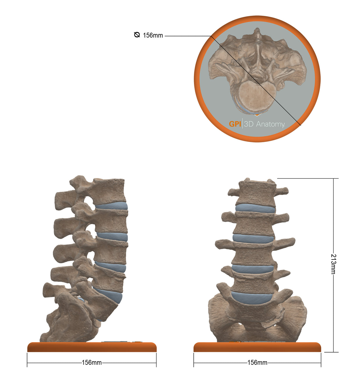 Custom 3D Anatomy Models | Spine | Spondylolysis | Pars Defect | Grade ...