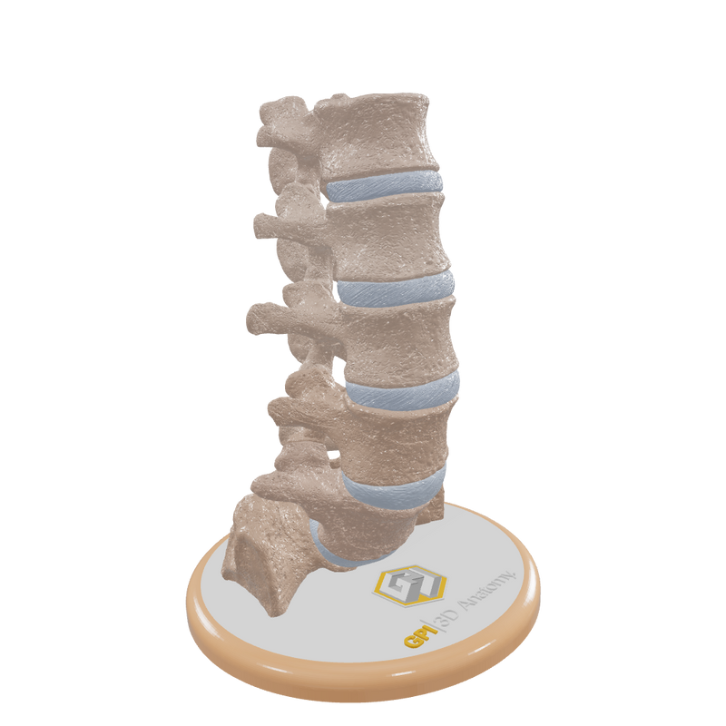 Custom 3D Anatomy Models | Spine | Spondylolysis | Pars Defect | Grade ...