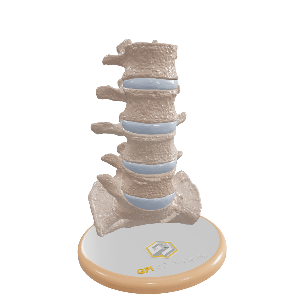 Custom 3D Anatomy Models | Spine | Spondylolysis | Pars Defect | Grade ...