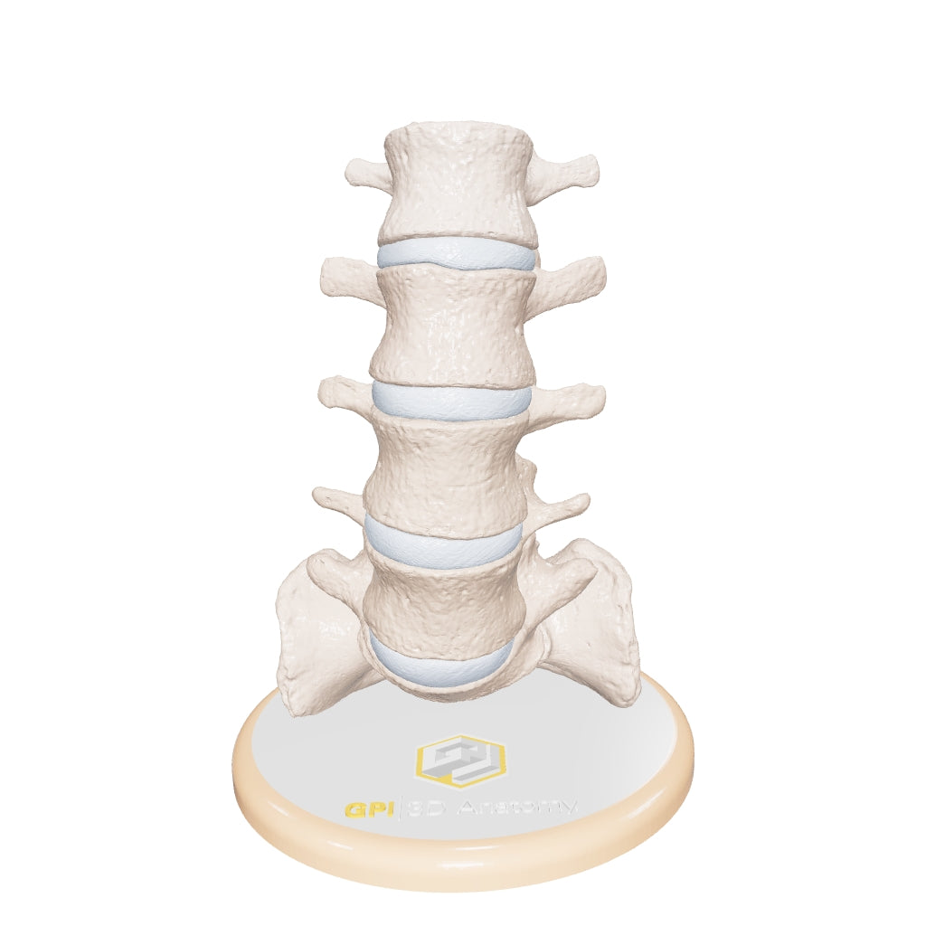 Custom 3D Anatomy Models | Spine | Spondylolisthesis | Pars Defect ...