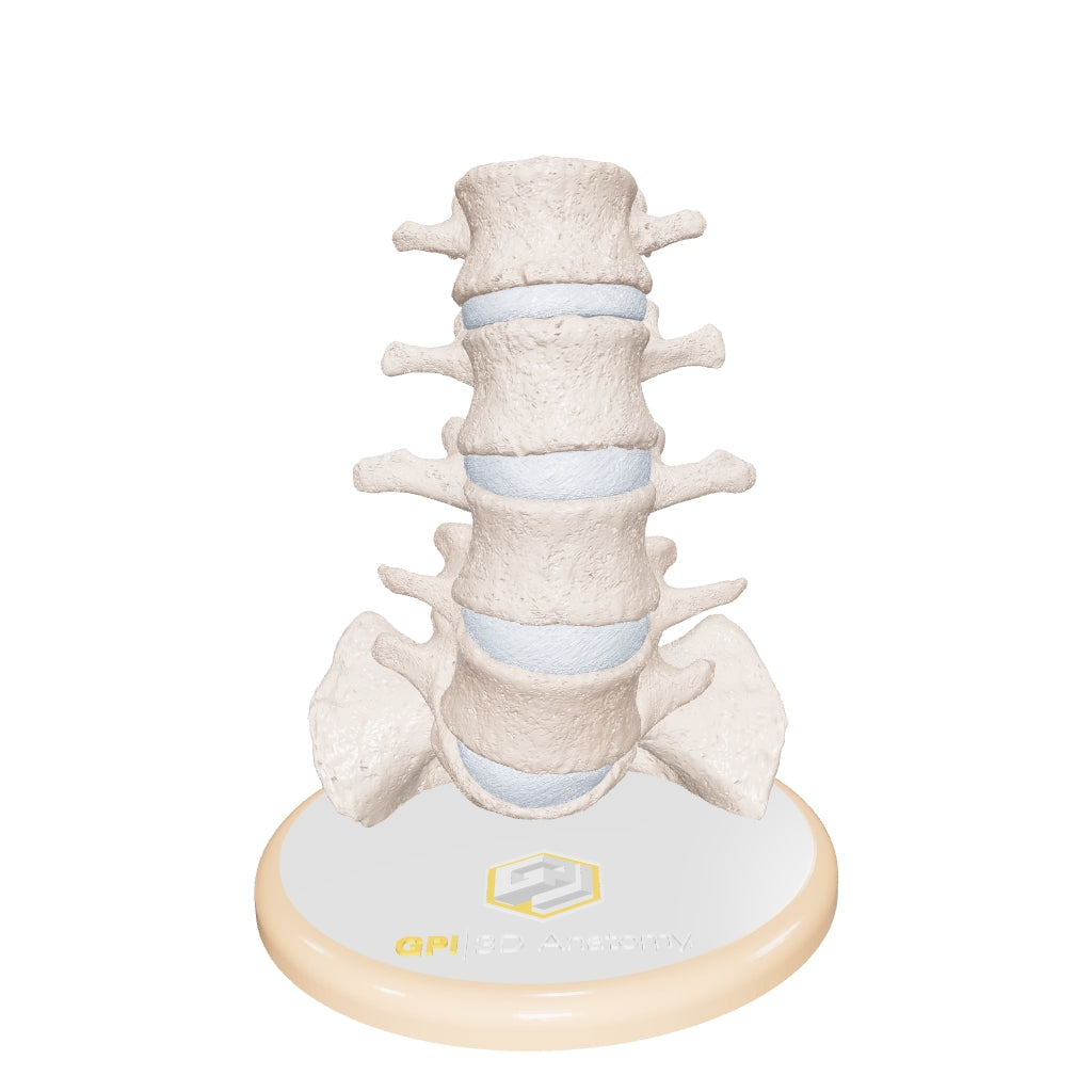 Custom 3D Anatomy Models | Spine | Spondylolysis | Pars Defect | Grade ...