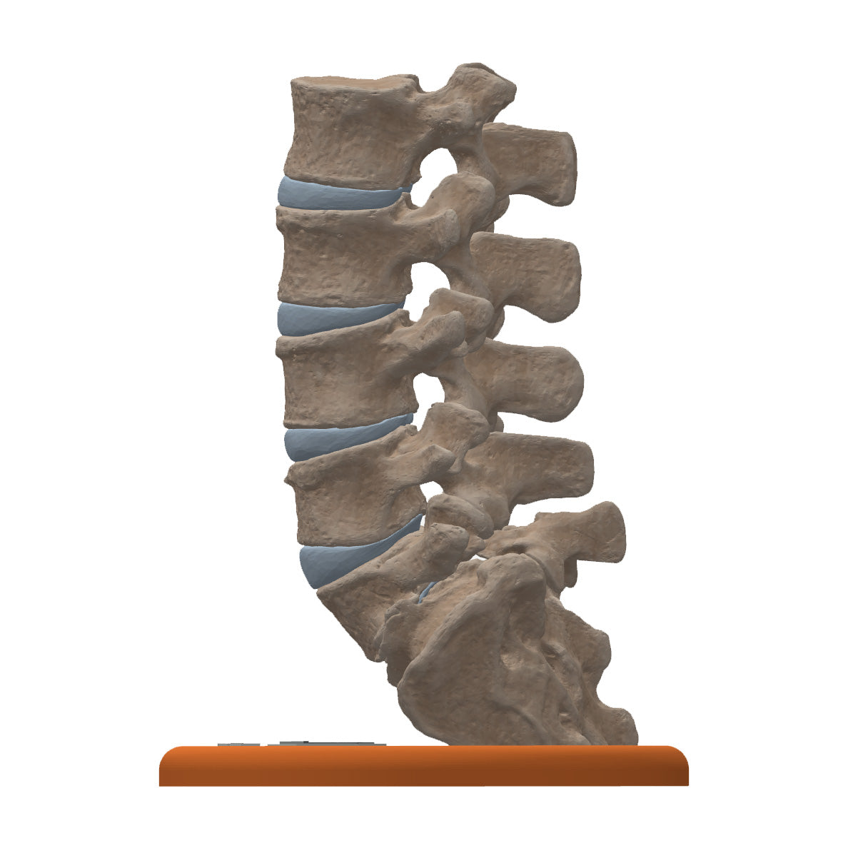 Custom 3D Anatomy Models | Spine | Spondylolysis | Pars Defect | Grade ...